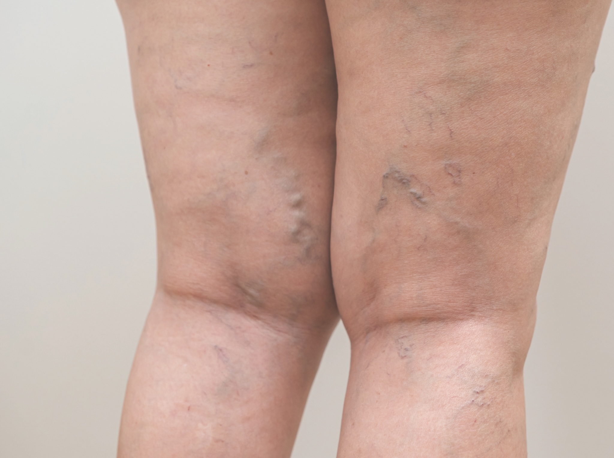 Comment prévenir et traiter les varices | Protégez-Vous.ca