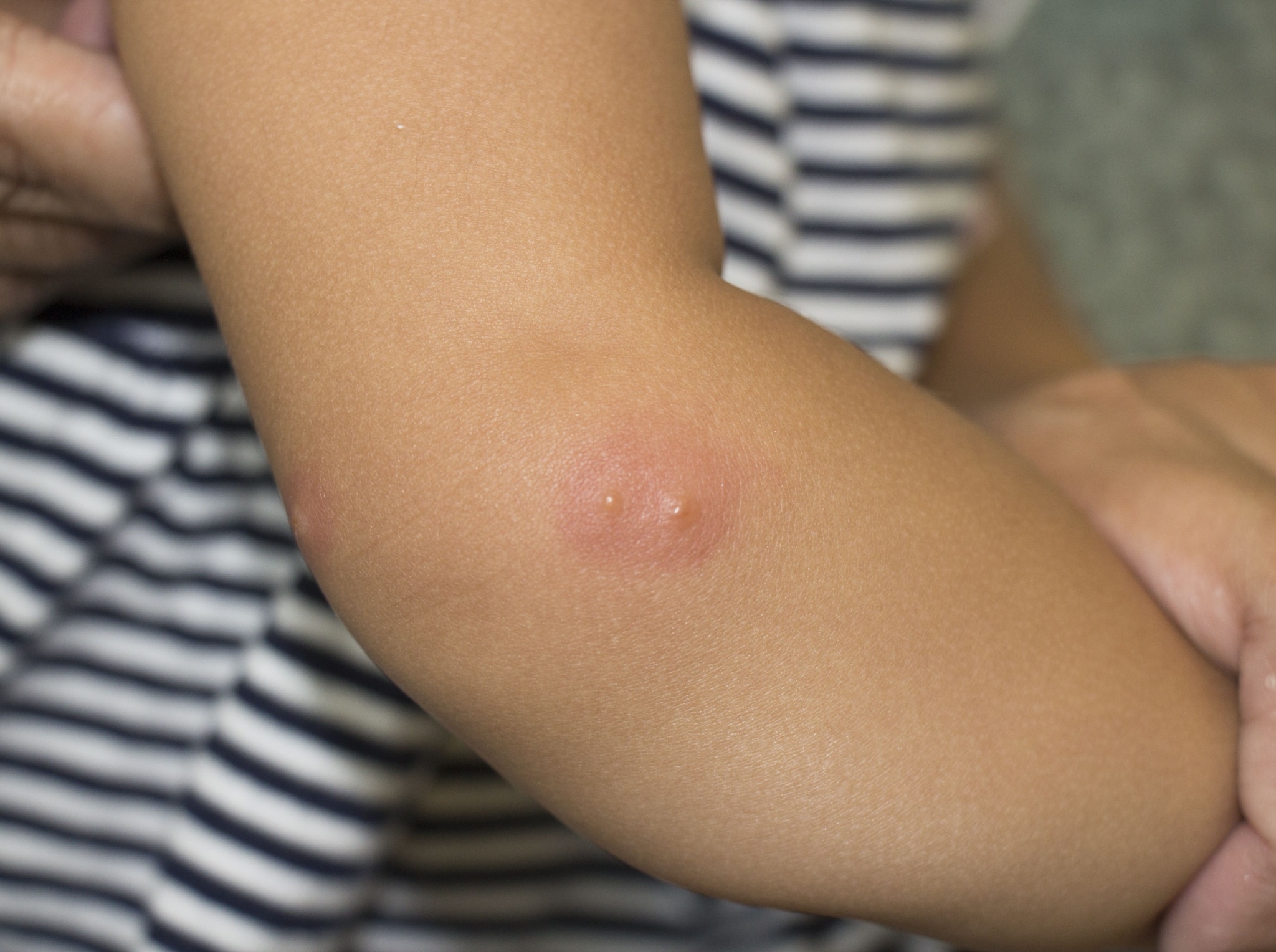 Enfant piqué par un insecte: quoi faire? | Protégez-Vous.ca